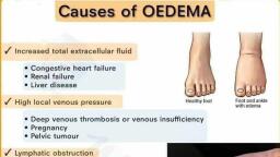 Oedema - Health - Assignment - Teachmint